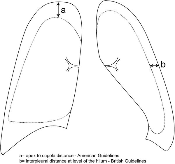 Spontaneous pneumothorax - WikEM