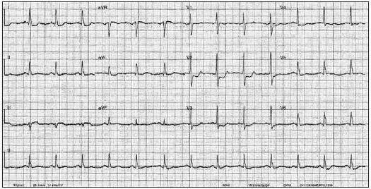 STEMI equivalents - WikEM