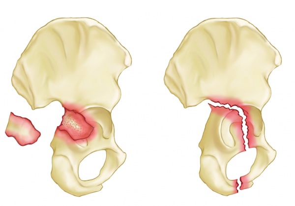 Acetabular pelvic fractures - WikEM