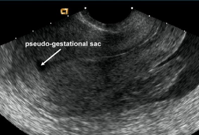 Ultrasound: Pelvic - WikEM