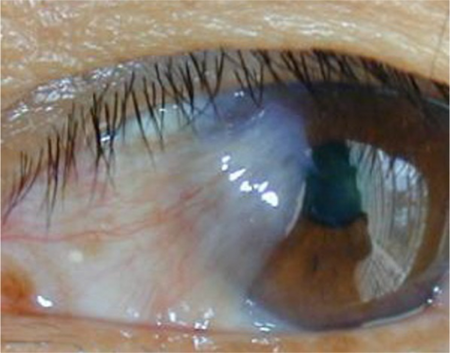 Pterygium - WikEM