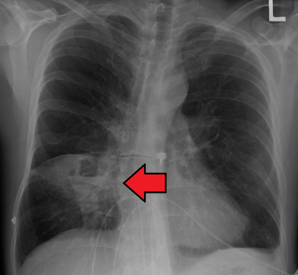 Lung abscess - WikEM