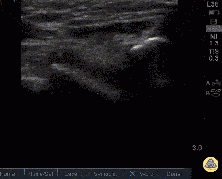 Quadriceps tendon rupture - WikEM