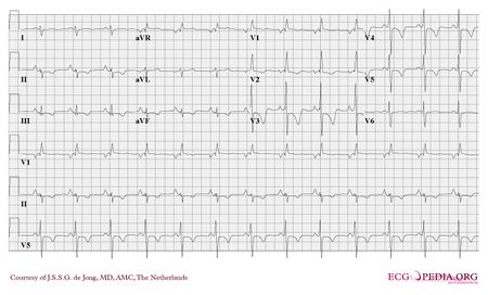 Right ventricular hypertrophy - WikEM