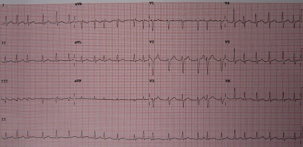 Atrial fibrillation with RVR - WikEM