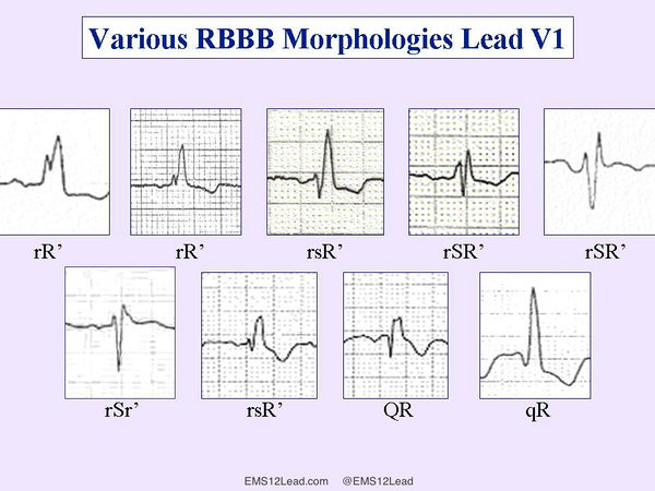 Right bundle branch block - WikEM