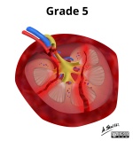Renal trauma - WikEM