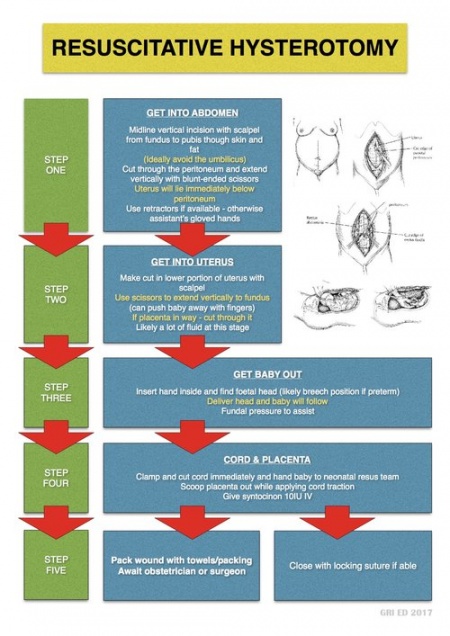 Resuscitative hysterotomy - WikEM