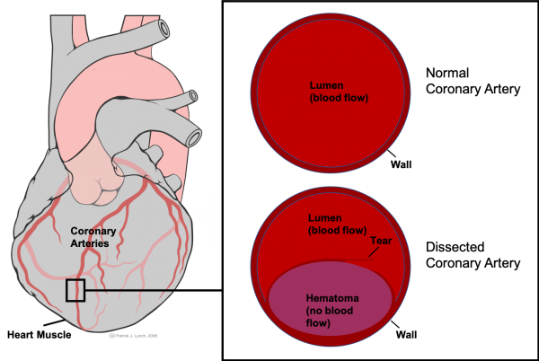 Coronary artery dissection - WikEM