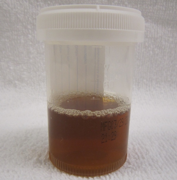 Abnormally colored urine - WikEM