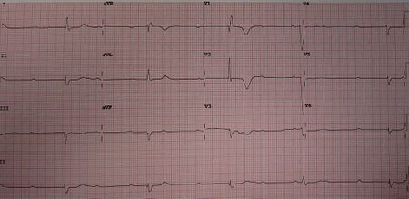 Third degree AV block - WikEM