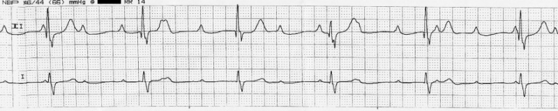 File:Rhythm strip showing third degree heart block.jpg - WikEM