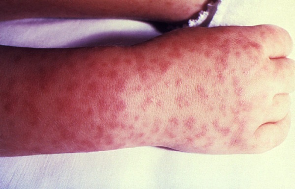 Rocky mountain spotted fever - WikEM