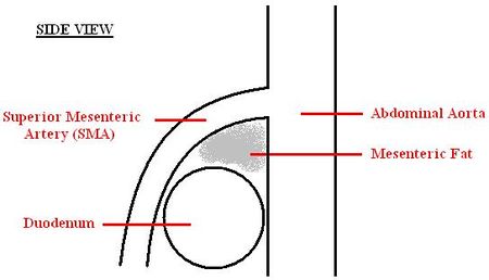Superior mesenteric artery syndrome - WikEM