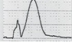 ST-segment elevation myocardial infarction - WikEM