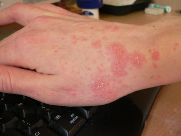 Maculopapular rashes - WikEM