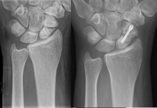 Scaphoid fracture - WikEM