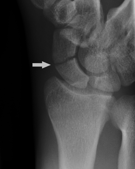 Scaphoid fracture - WikEM
