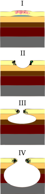 Pressure ulcer - WikEM