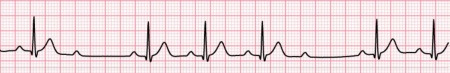 Second degree AV block type II - WikEM