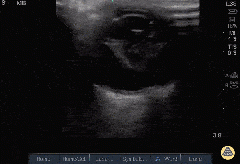 Ocular ultrasound - WikEM