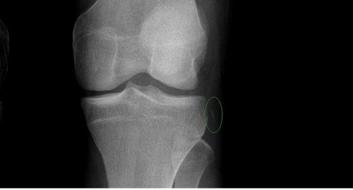 Knee x-rays - WikEM
