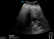 Renal ultrasound - WikEM