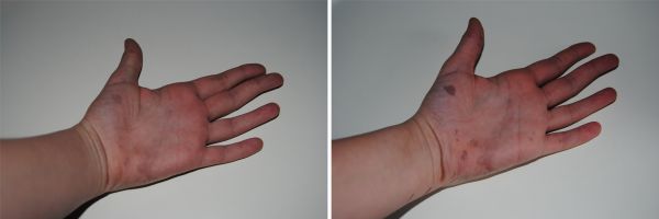 Caustic burn - WikEM