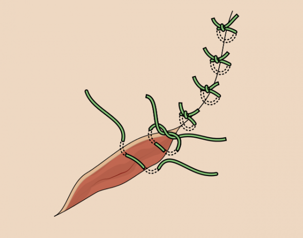 Laceration repair - WikEM