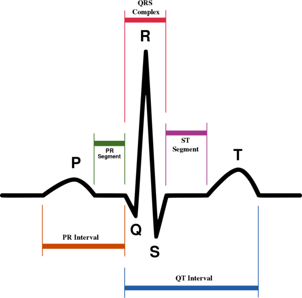 Pathologic Q waves - WikEM