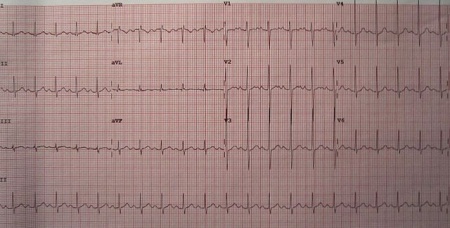 Sinus tachycardia - WikEM