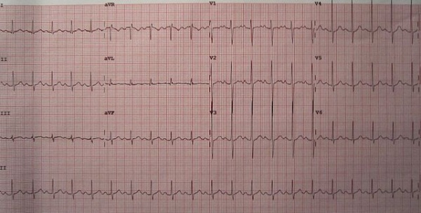 Sinus tachycardia - WikEM