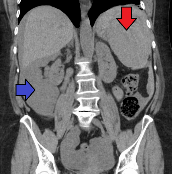 Splenic trauma - WikEM