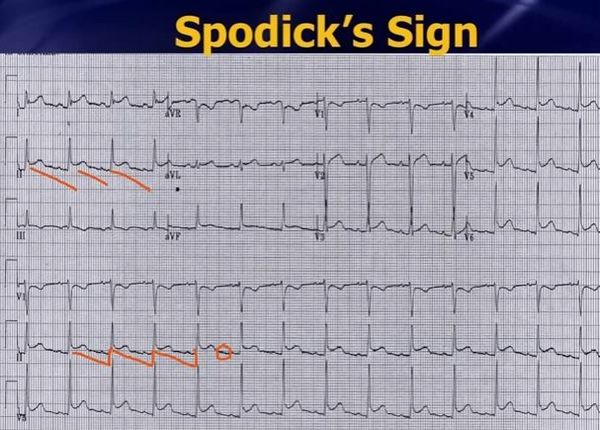 Pericarditis - WikEM
