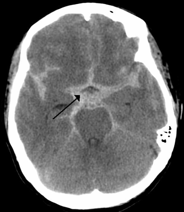 Subarachnoid hemorrhage - WikEM