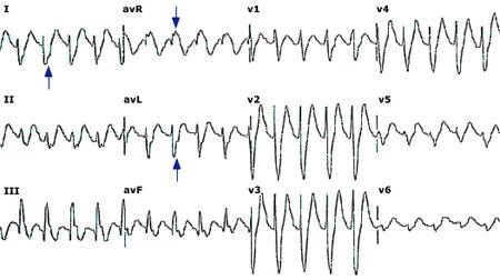 Tricyclic antidepressant toxicity - WikEM