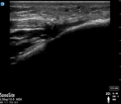 Ultrasound: Tendons - WikEM