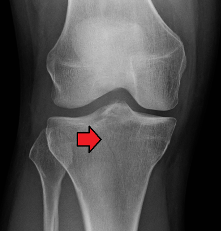 Tibial plateau fracture - WikEM