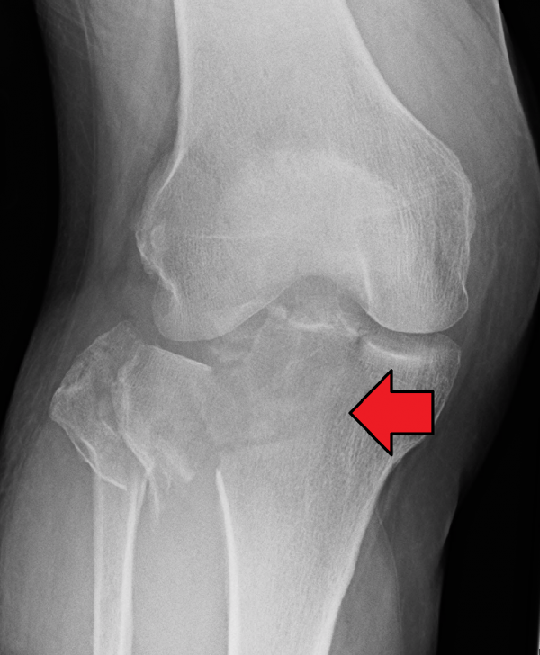 Tibial plateau fracture - WikEM