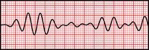 ACLS: Tachycardia - WikEM