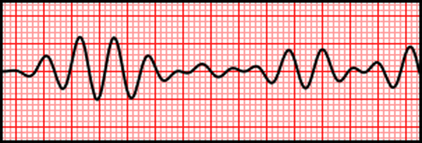 ACLS: Tachycardia - WikEM