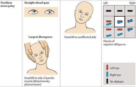 Fourth nerve palsy - WikEM