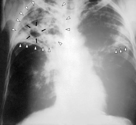 Tuberculosis - WikEM