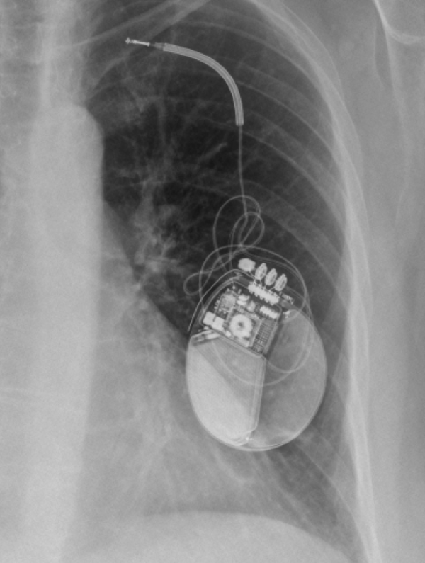 Pacemaker complication - WikEM