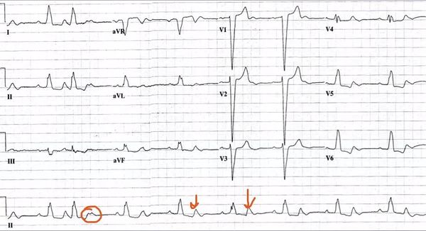 Second degree AV block type II - WikEM