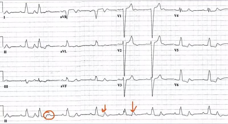 File:Type 2 - buried p wave.JPG - WikEM