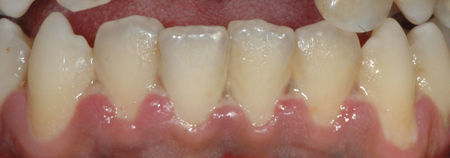 Acute necrotizing ulcerative gingivitis - WikEM