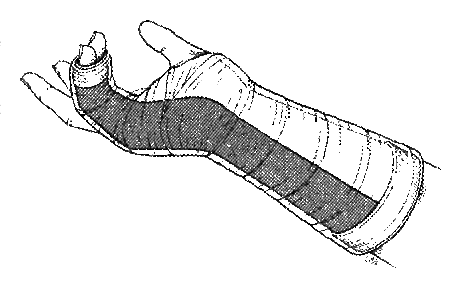 Ulnar gutter splint - WikEM
