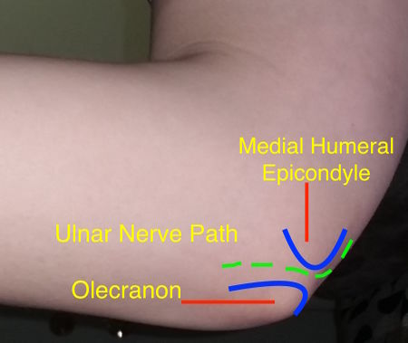 Nerve Block: Ulnar Nerve - WikEM
