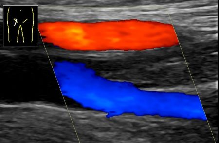 DVT ultrasound - WikEM